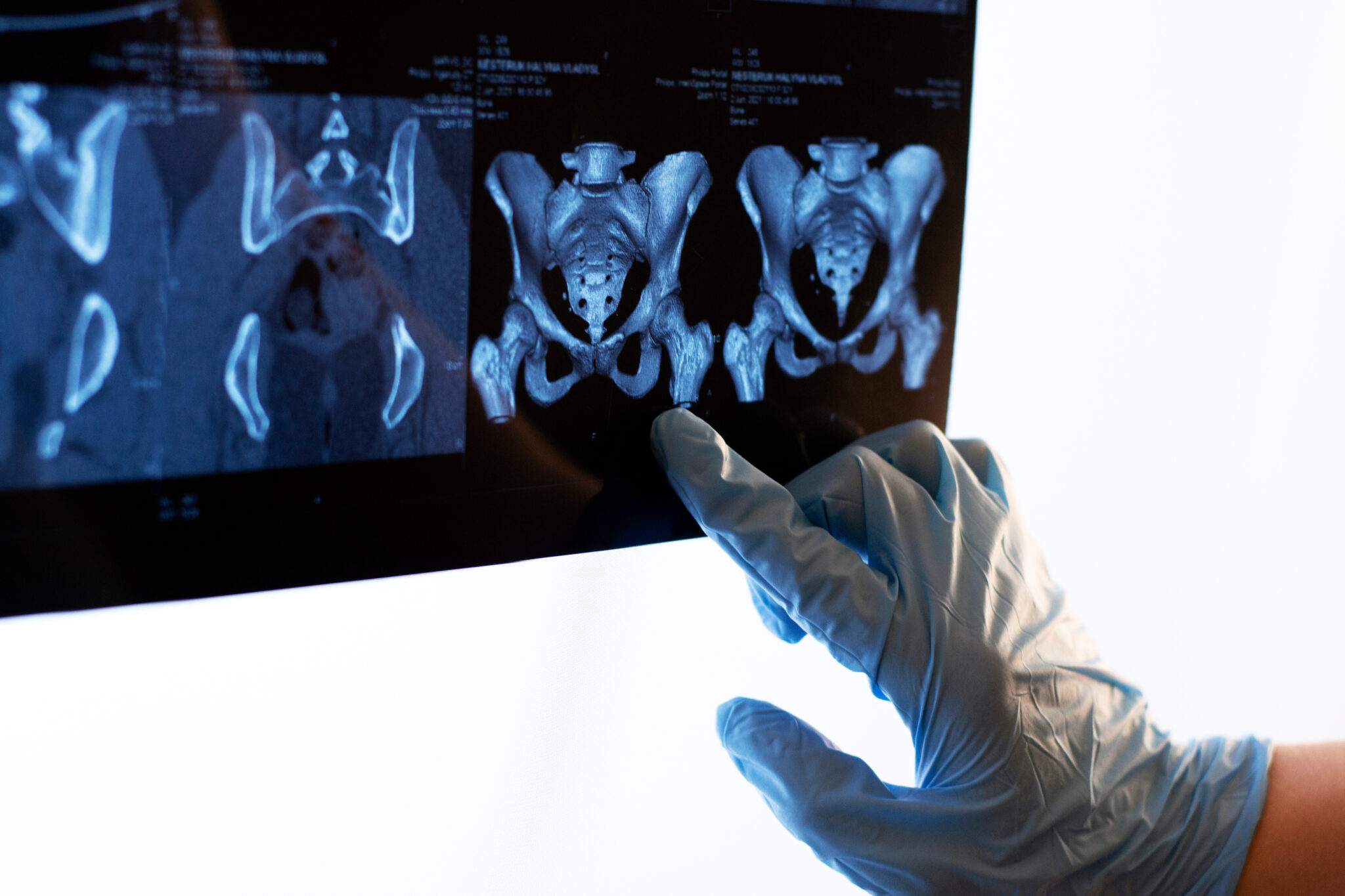 Buffalo Spine & Sports Medicine - Buffalo, NY - iFuse INTRA X ...