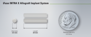 Buffalo Spine & Sports Medicine - Buffalo, NY - iFuse INTRA X ...